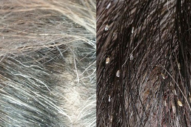 A Detailed Guide To Understanding And Treating Scalp Scabs