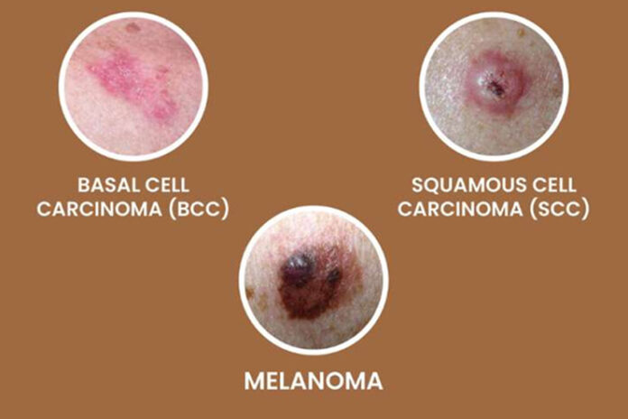 Early Signs Of Skin Cancer | Kinds Of Skin Cancer