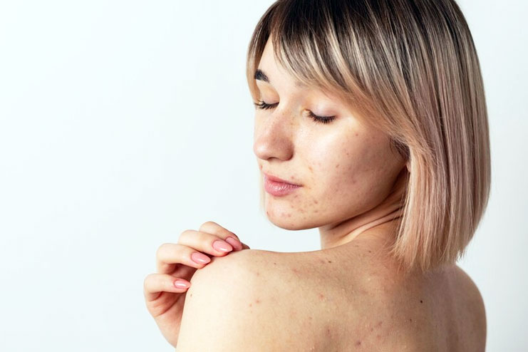 How to Get Rid of Rash on Neck