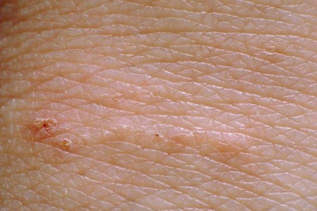 How to treat and prevent scabies in humans