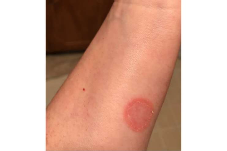 17 Effective Home Remedies and Treatments for Ringworm