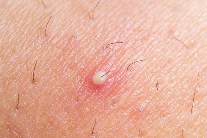 18 Ways To Get Rid of Ingrown Hair at Home