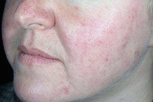 12 Easy and Effective Remedies to Get Rid of Redness Of Face Naturally