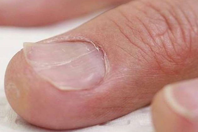 What Fingernails Tell About Your Health? 12 Possible Facts