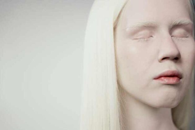 The Art of Calling in Sick - 14 Ways to Make Yourself Look Sick