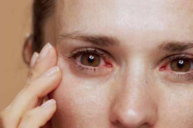 The Art of Calling in Sick - 14 Ways to Make Yourself Look Sick