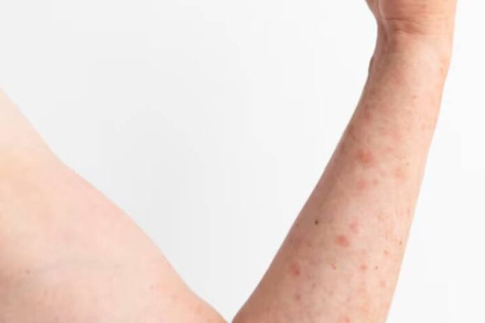 Foods That Trigger Hives: What to Avoid