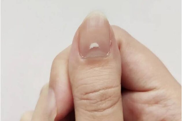 How to Remove White Spots on Nails