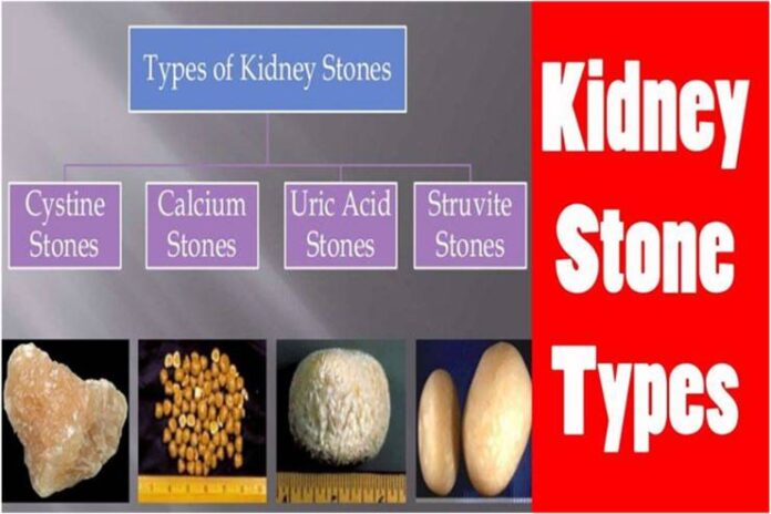 Kidney Stones: Types, Causes, Symptoms, and Diet