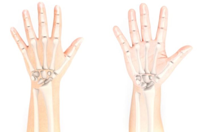 Wrist Fractures: Most Common Types and What Recovery Looks Like