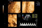 When Is the Best Time to Get a 4D Ultrasound? What to Know for the ...
