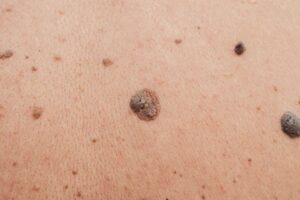 7 Types of Moles on Your Body That Could Signal Serious Health Issues