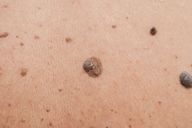 7 Types of Moles on Your Body That Could Signal Serious Health Issues