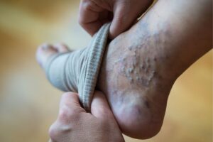Hidden Signs of Poor Blood Circulation You Shouldn’t Ignore