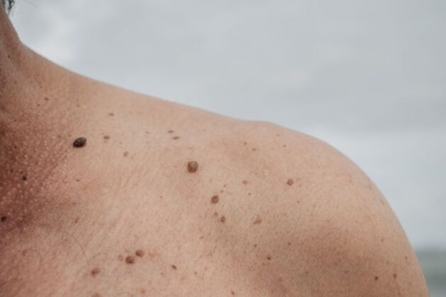 7 Types of Moles on Your Body That Could Signal Serious Health Issues