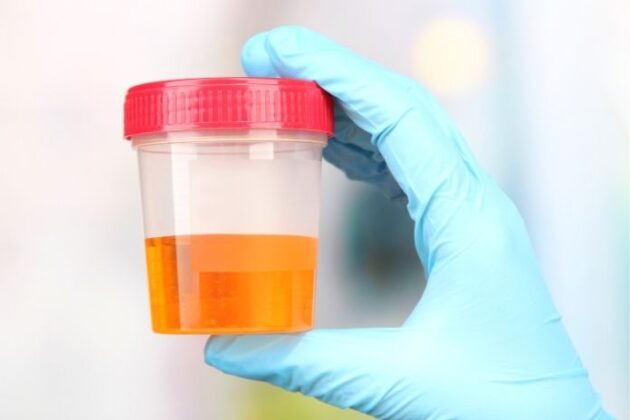 Why Is My Urine Brown? Causes, Symptoms, and When to See a Doctor