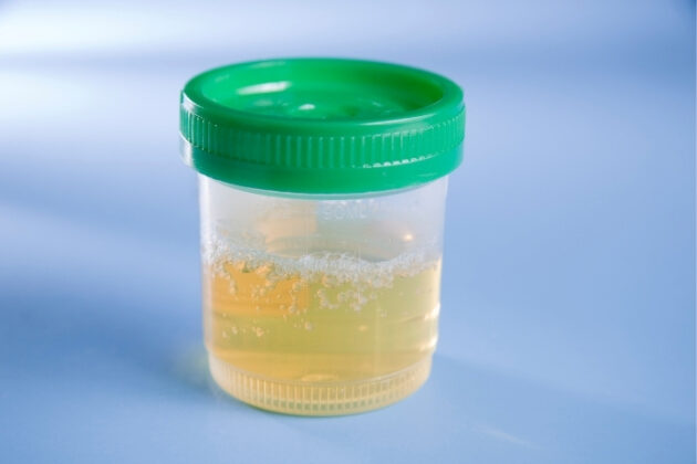 Foamy Urine: What It Means About Your Kidney Health
