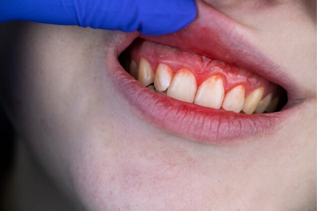 Why Do My Gums Bleed When I Brush? Causes and Remedies