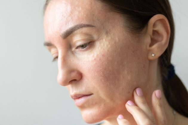 Why Is My Skin Suddenly Very Dry Even Though I Use Moisturizer ...