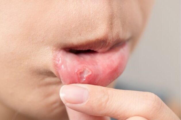 What Is Oral Thrush? Causes, Symptoms, and Treatment Explained