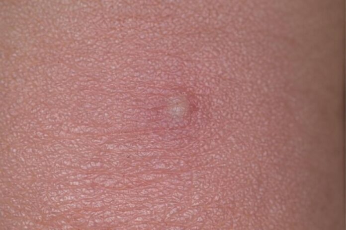 Why Carbuncles Keep Coming Back: Causes, Risk Factors, and Prevention