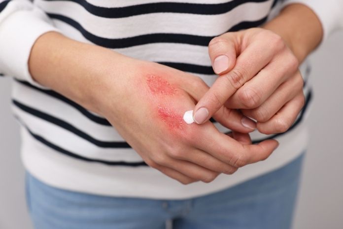 It’s Been 6 Months: Why Your ‘Margarita Burn’ Is Still Purple—and How ...